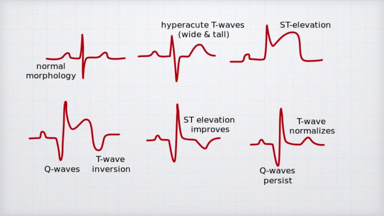 Easy ECG | Module 3 | ECG changes in coronary heart diseases - YouTube