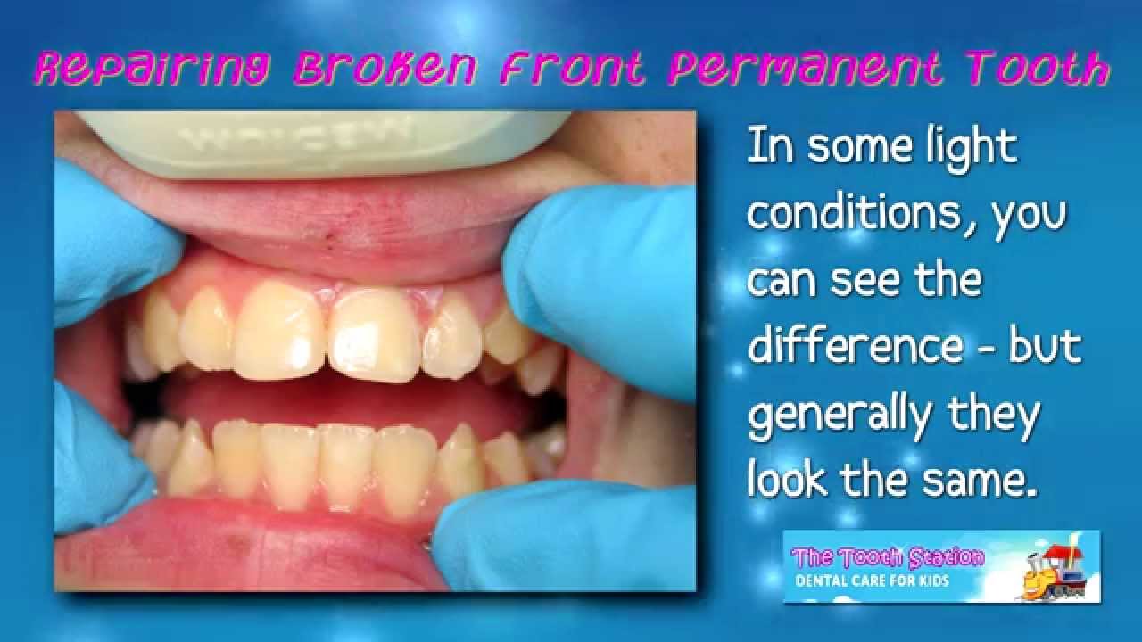 Anterior Fracture Repair - The Tooth Station - YouTube