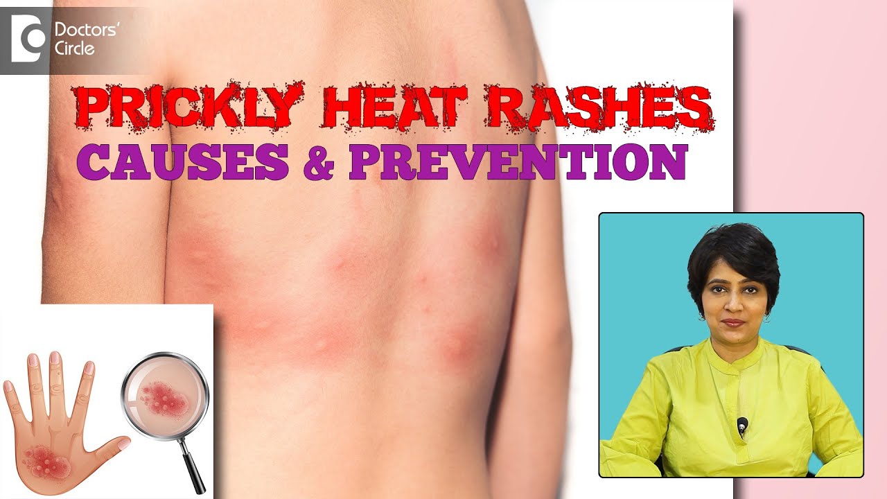 Prickly Heat Summer Rash Know The Causes And Tips To Prevent It Dr