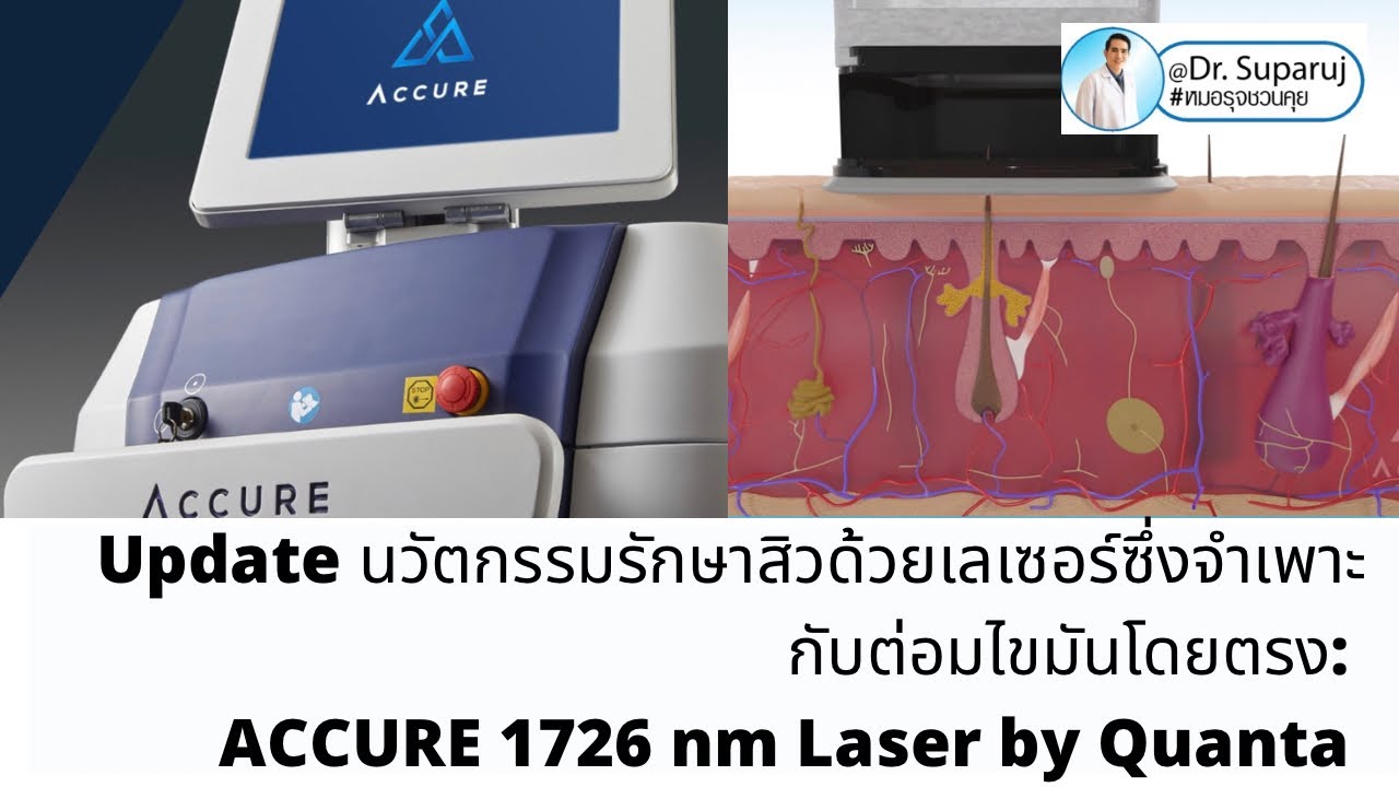 นวัตกรรมรักษาสิวด้วยเลเซอร์ซึ่งจำเพาะกับต่อมไขมันโดยตรง: ACCURE 1726 nm ...