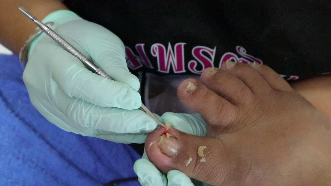 Ep_252 👣 Clawed nails👣 ขอบคุณลูกค้าจากอ่างทอง - YouTube