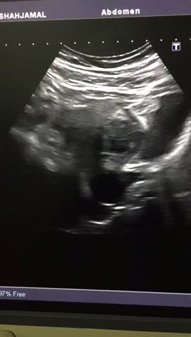 Subserosal Anterior wall Subserosal fibroid - YouTube