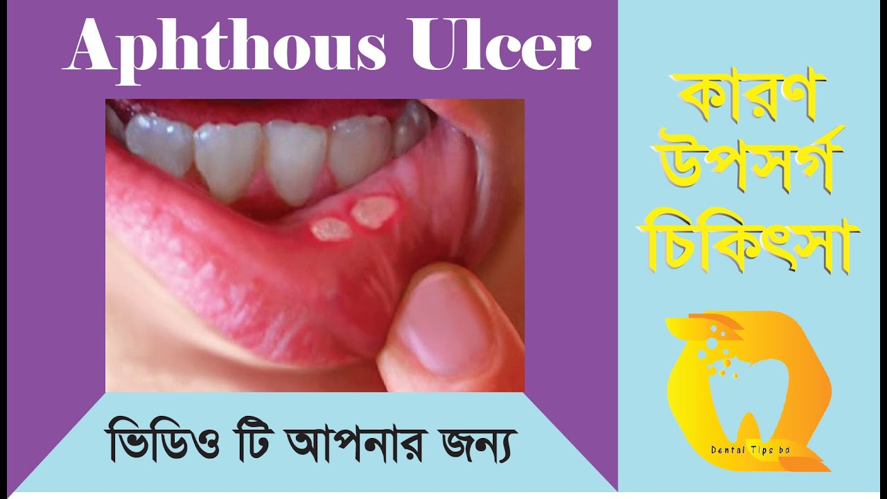 A new treatment for aphthous ulcers || এ্যপথাস আলসার সারানোর উপায় ...