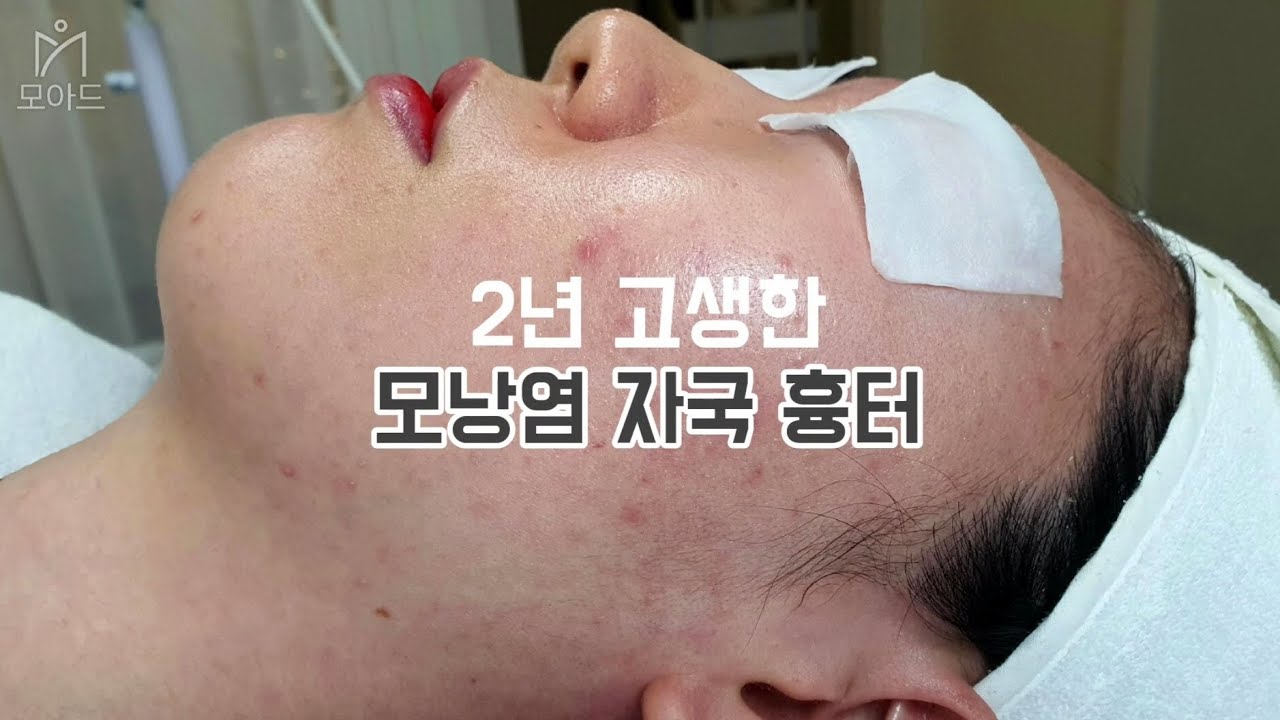 2년 고생한 모낭염 자국 흉터 개선 후기 건대 피부관리 모아드 Acne Scars Skin Care Reviews