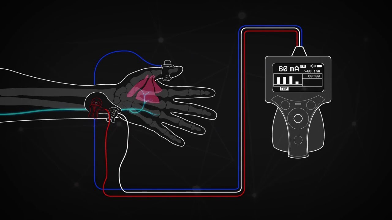 Train of Four Monitoring using the Ulnar Nerve - YouTube