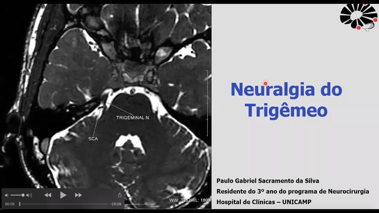 Neuralgia do Trigêmeo - YouTube