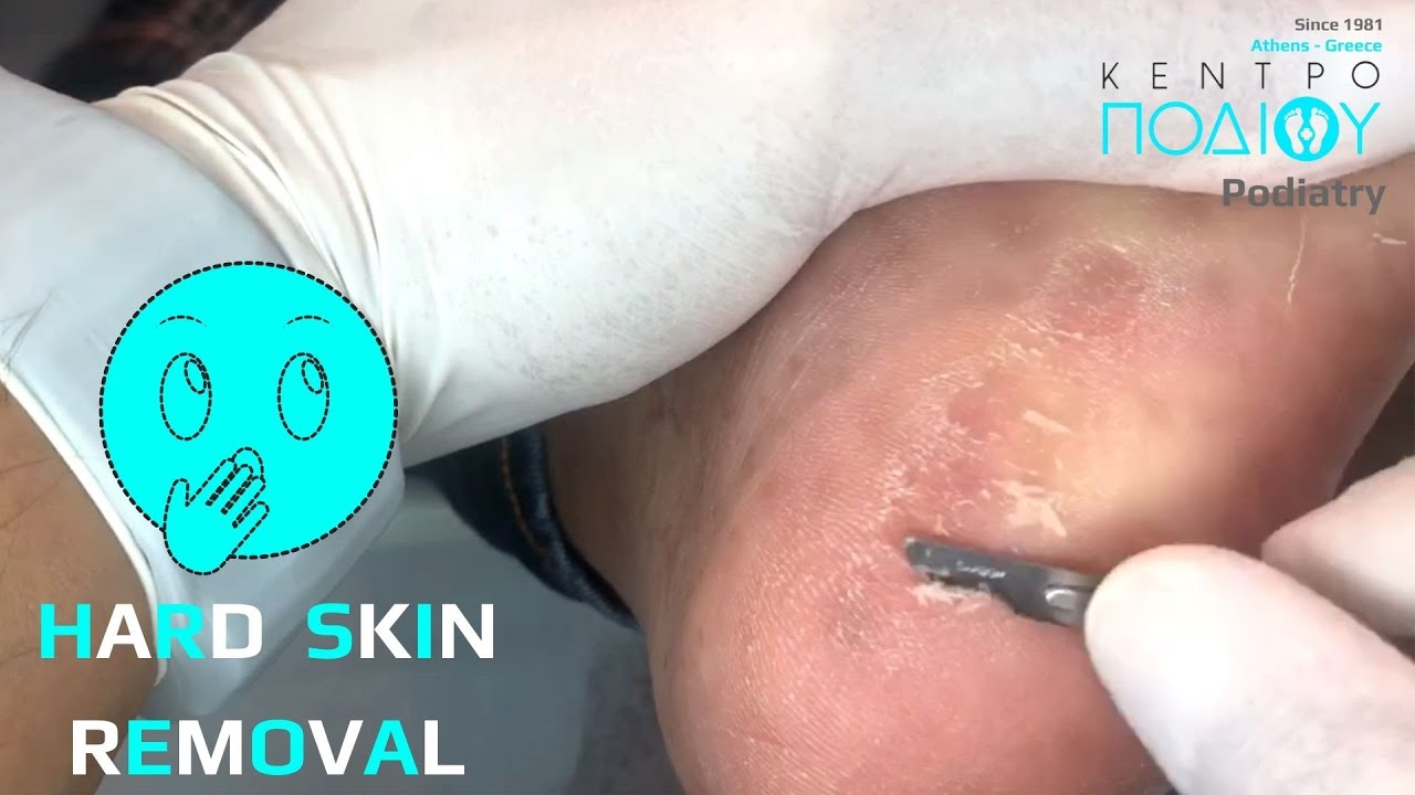 Heel calluses removal|Αφαίρεση σκληρύνσεων|Κέντρο Ποδιού Podiatry ...