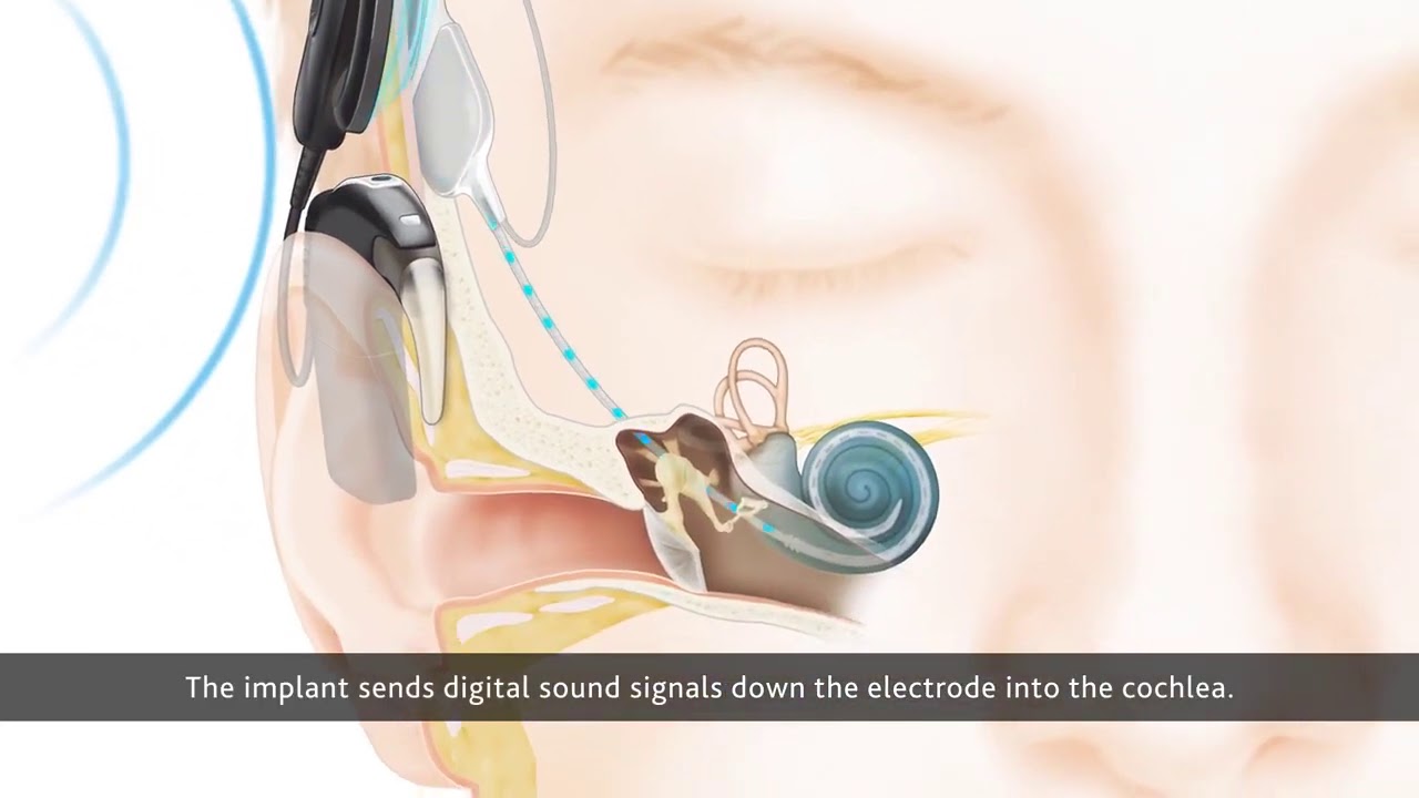 How cochlear implants work - YouTube