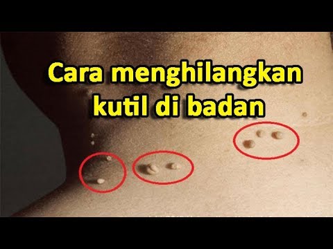 TIPS JITU !!! Cara menghilangkan kutil di badan secara alami - YouTube