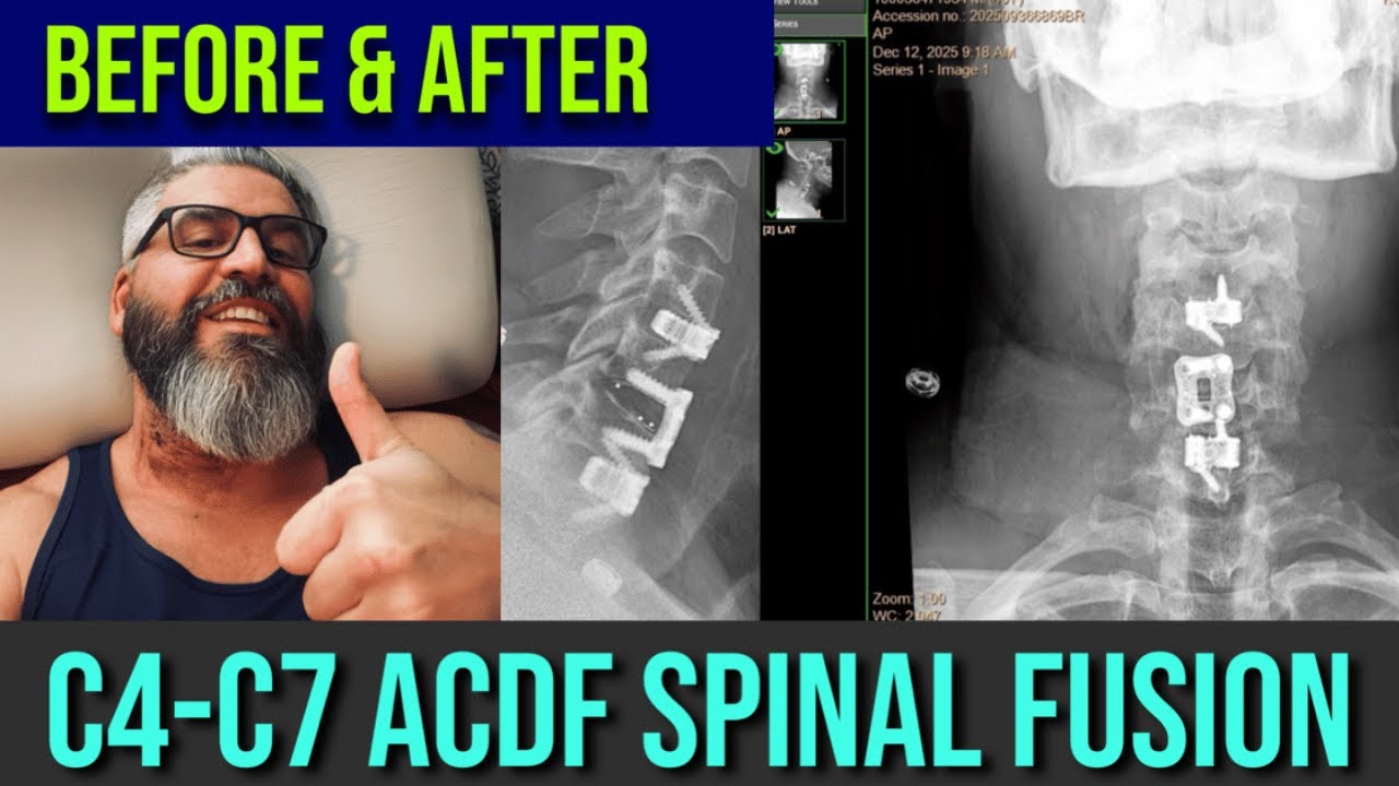 My Cervical Spine Fusion (C4–C7): Surgery Day, Recovery & Hope - YouTube