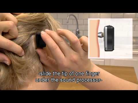 Baha - Removing the sound processor - YouTube