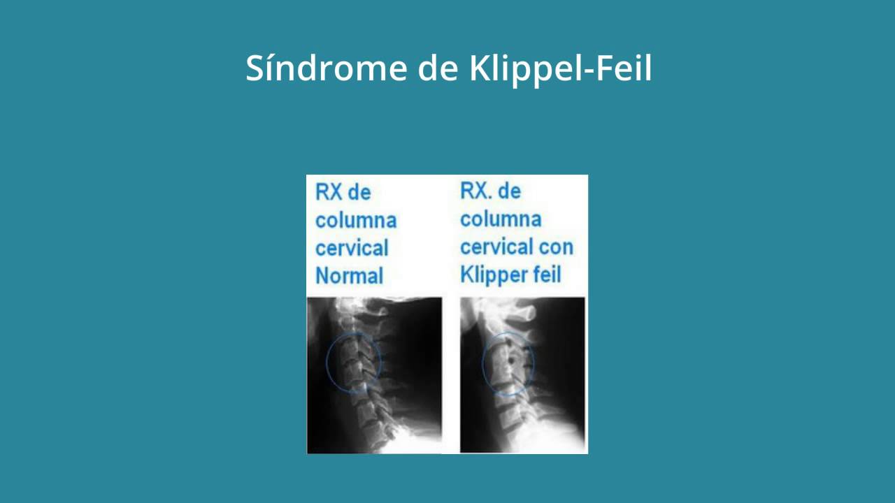 Síndrome de Klippel-Feil - YouTube