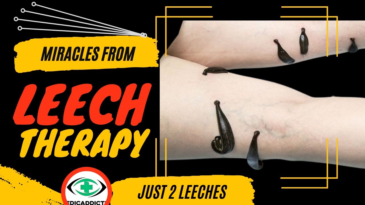 Leech Therapy For Knee Pain & Varicose Veins #leechtherapy #ayurveda ...