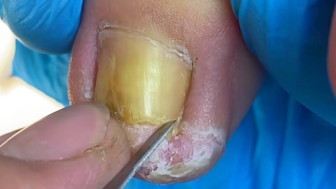 Huge Ingrown Nail Removed From Very Thick and Hard Toenail Fungus ...