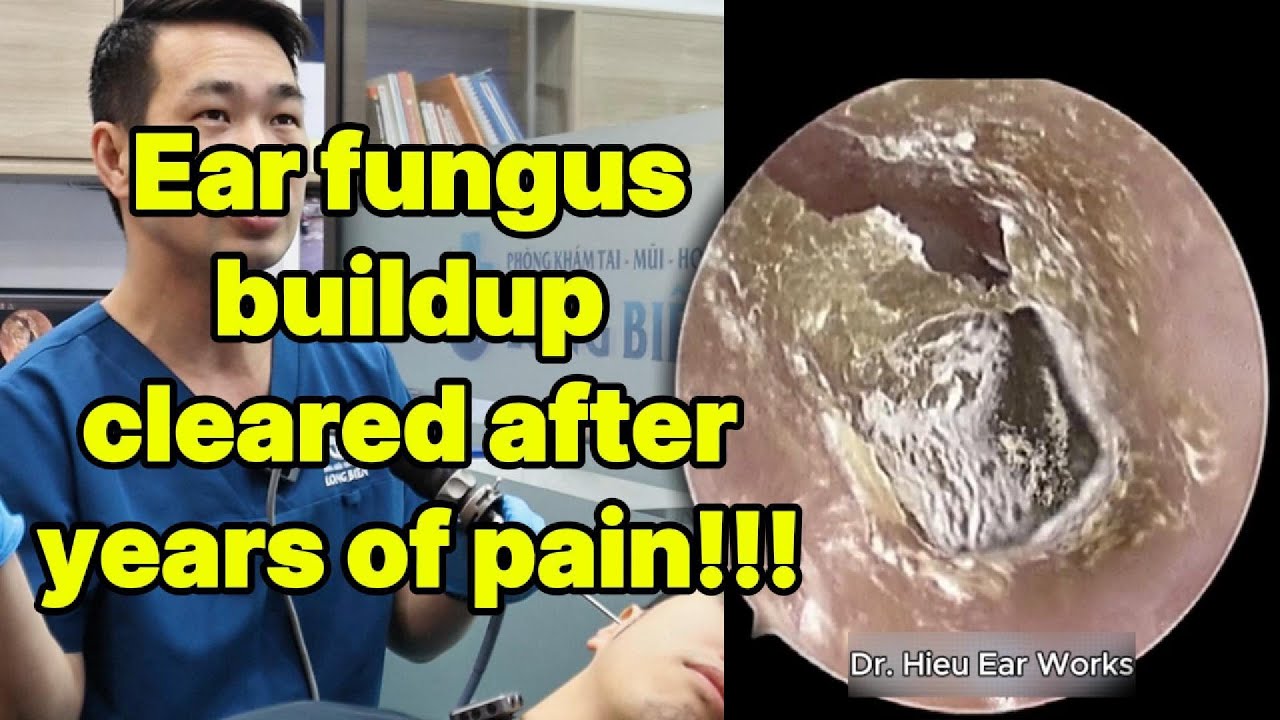 Ear fungus buildup cleared after years of pain | ear cleaning | ASMR ...