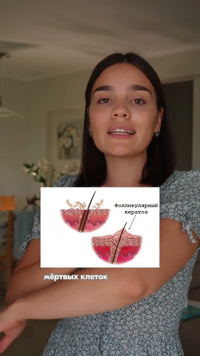 Средство, которое подошло мне NO ACNE SKIN LIKATO. - YouTube