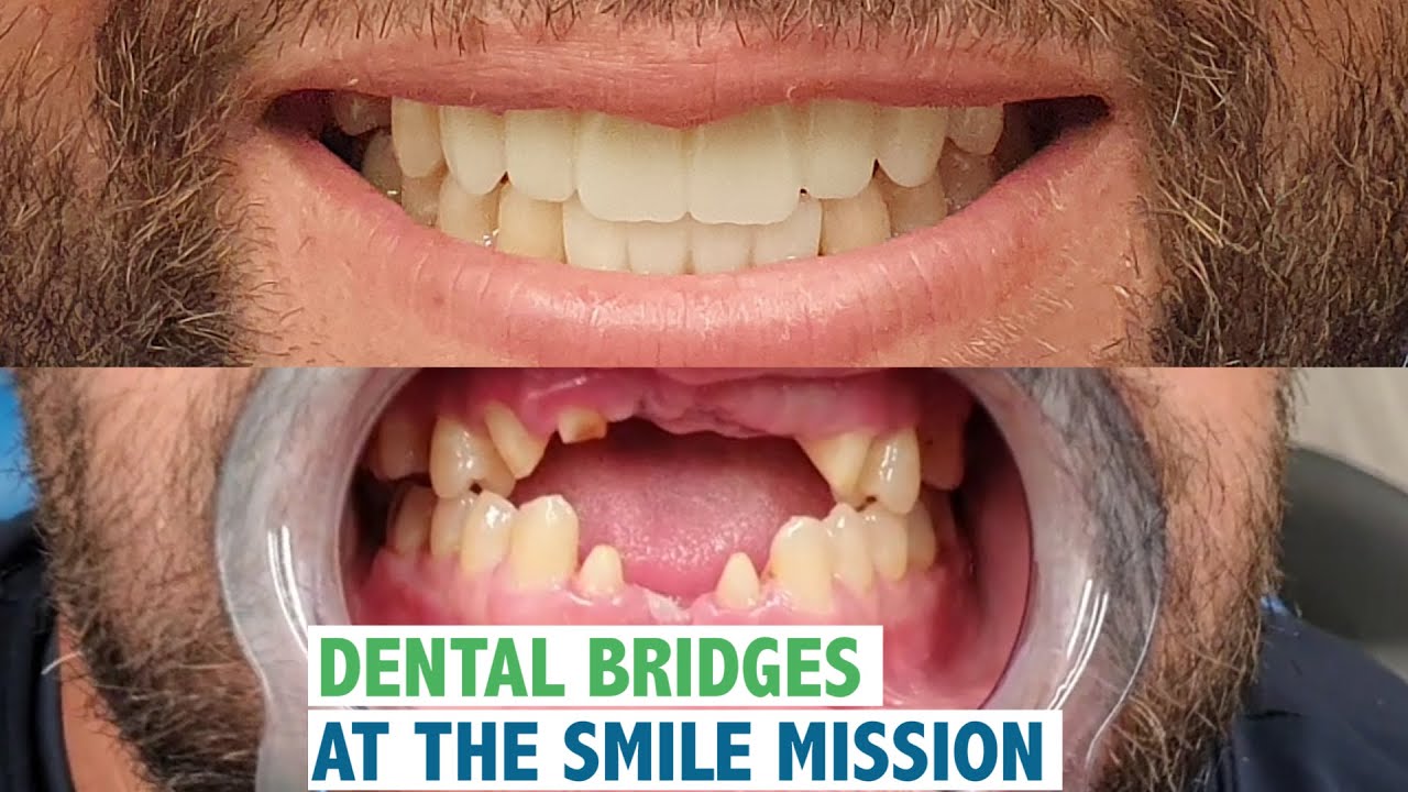 Dental Bridges At The Smile Mission - YouTube