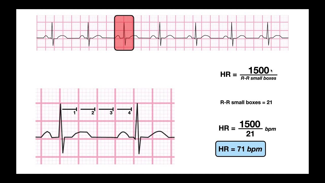 Determine HR from a Regular-Rhythm EKG | 1500- & 300-methods - YouTube