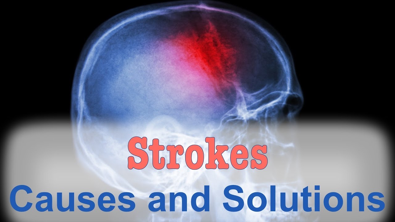 The Natural Solution for Strokes - YouTube