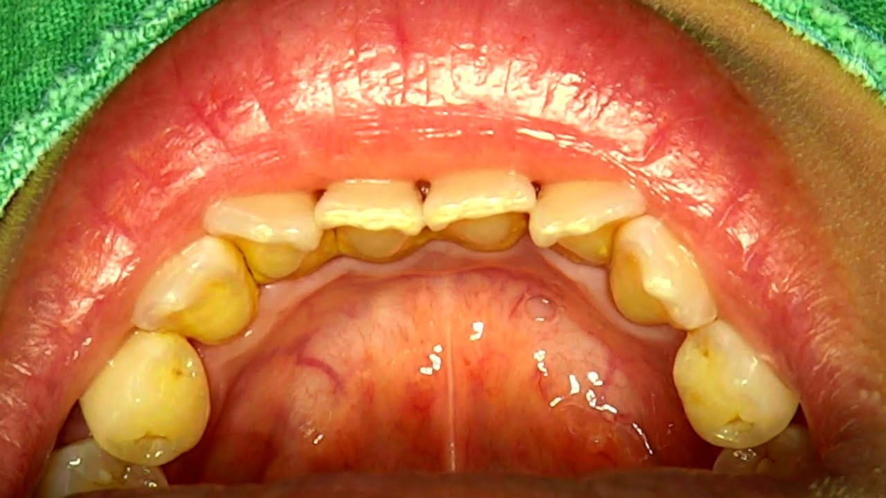 remove tartar calculus scaling 치석제거 스케일링 잠실새내치과 잠실새내역치과 잠실원치과의원 - YouTube