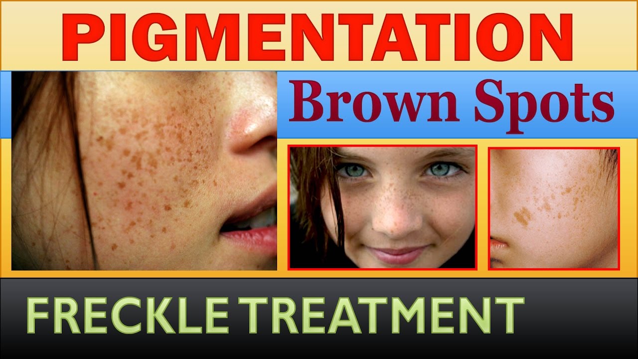 Pigmentation, Freckle, Brown Moles and Spots Complete Treatment with ...