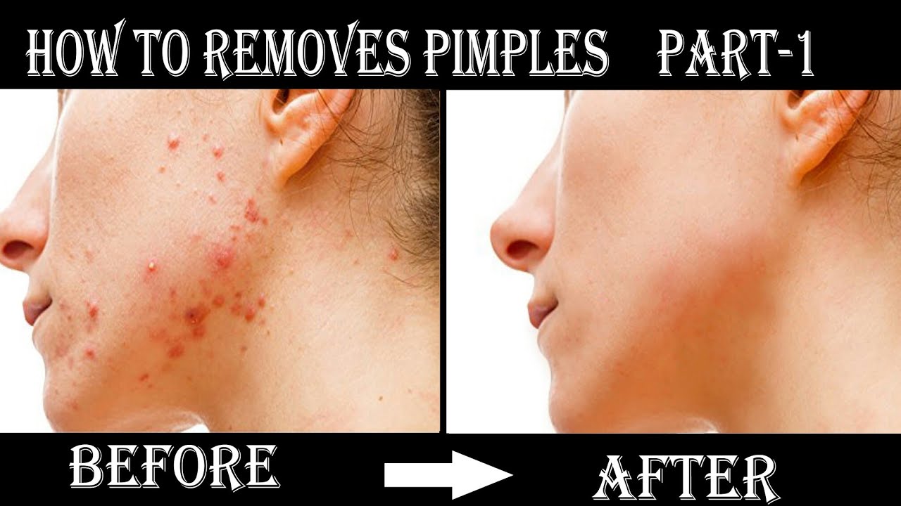 How To Remove Pimples In Photoshop Cs6 YouTube how-to-remove-pimples-in-photoshop-cs6-youtube