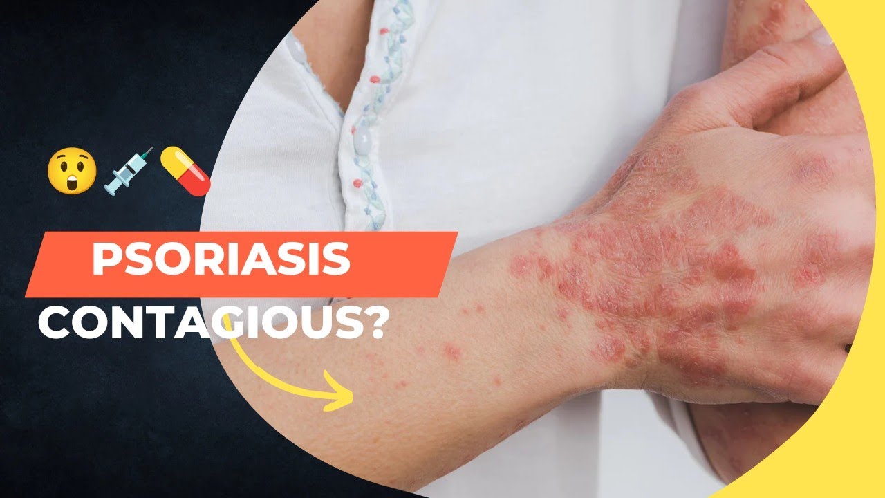 How is Psoriasis Contagious? | Psoriasis Homeo Treatment - YouTube