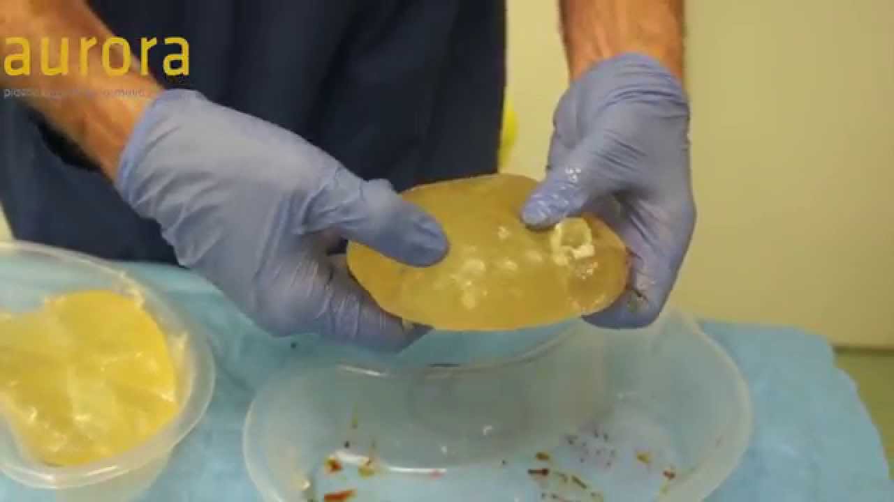 Ruptured PIP Implants (No Surgery) - YouTube