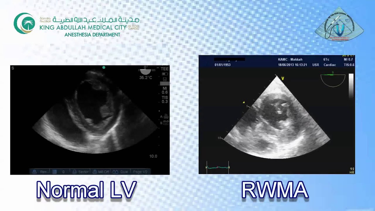 054 Regional LV Function RWMA TEE KAMC - YouTube
