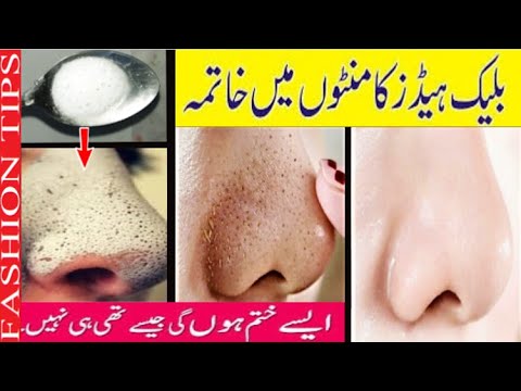 In Just 5 Mints Best Way to Remove BLACKHEADS and WHITEHEADS ...