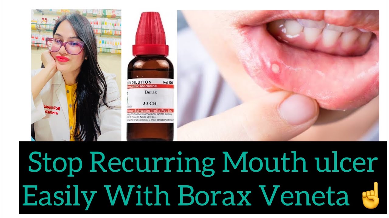 Recurring Mouth Ulcers? Oral Thrush Best Homeopathic Medicine? Borax ...