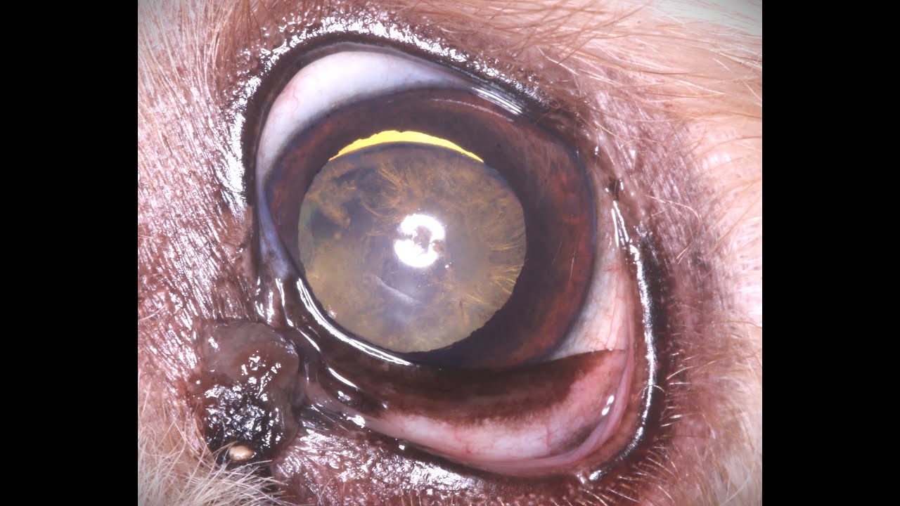 Chirurgie luxation antérieure cristallin - YouTube