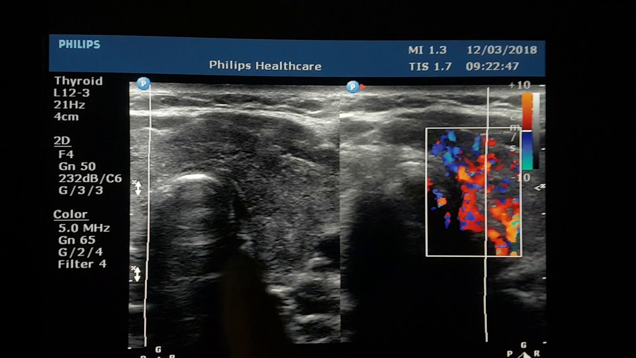 Hashimotos Thyroiditis Ultrasound Findings