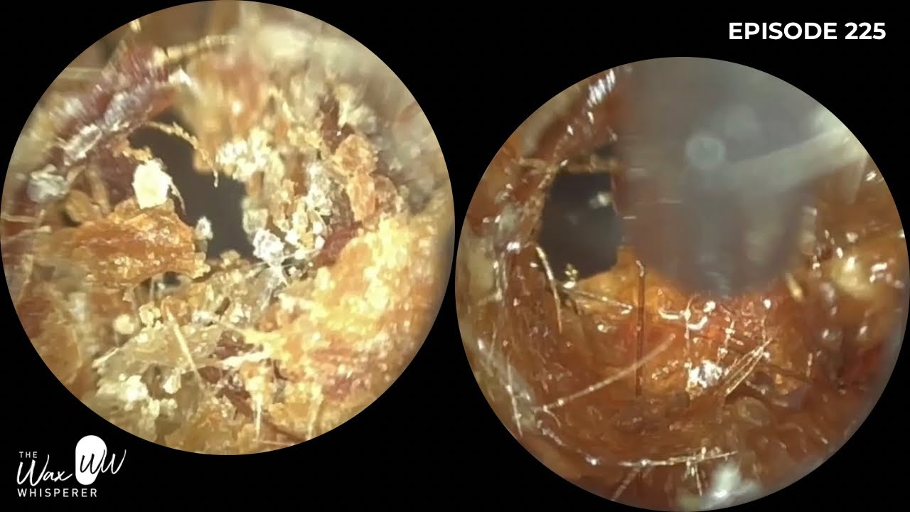 225 - Dry Crusted Dead Skin Removal using the WAXscope®️ - YouTube