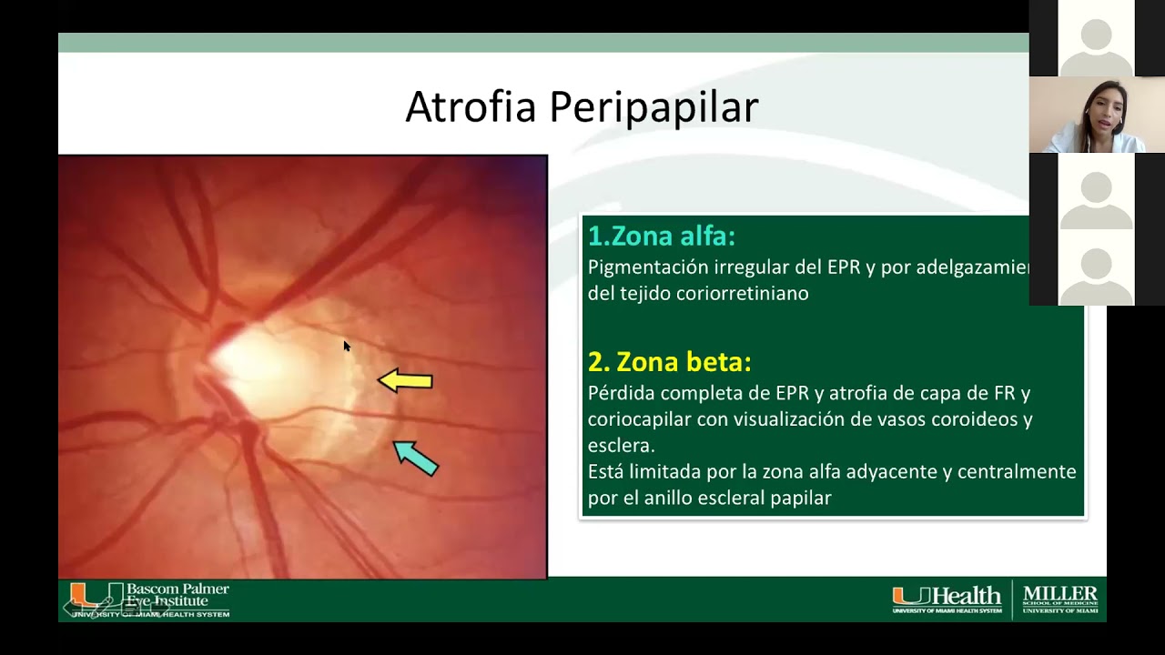 Atrofia Peripapilar Zonas Alfa E Beta Assessment Of β Zone