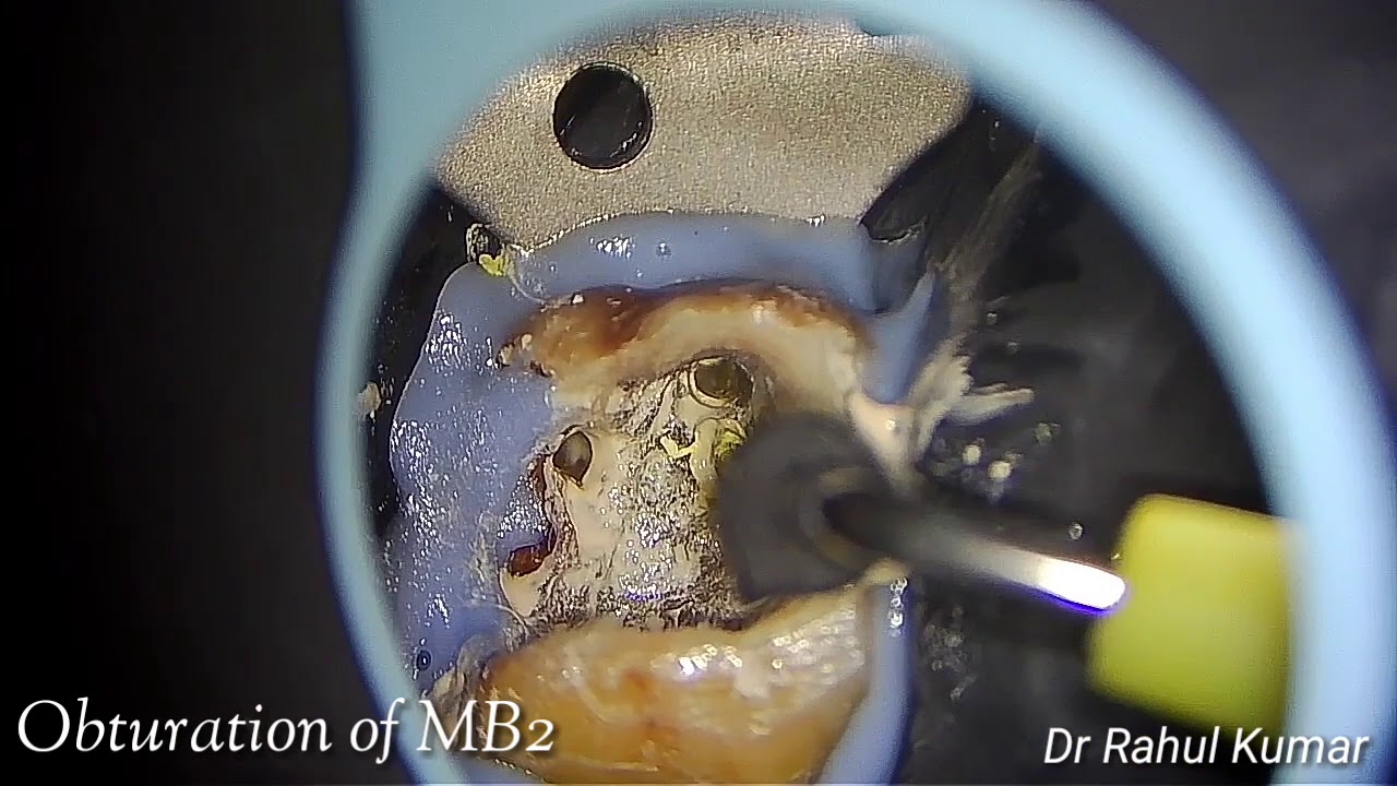 Step by step procedure for warm vertical obturation.. - YouTube