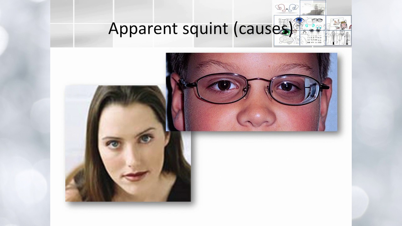 Apparent squint - YouTube
