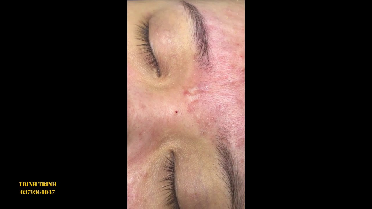 Squeeze Blackheads, Whiteheads| ACNE TREATMENT| CÁCH NẶN MỤN SẠCH NHÂN ...