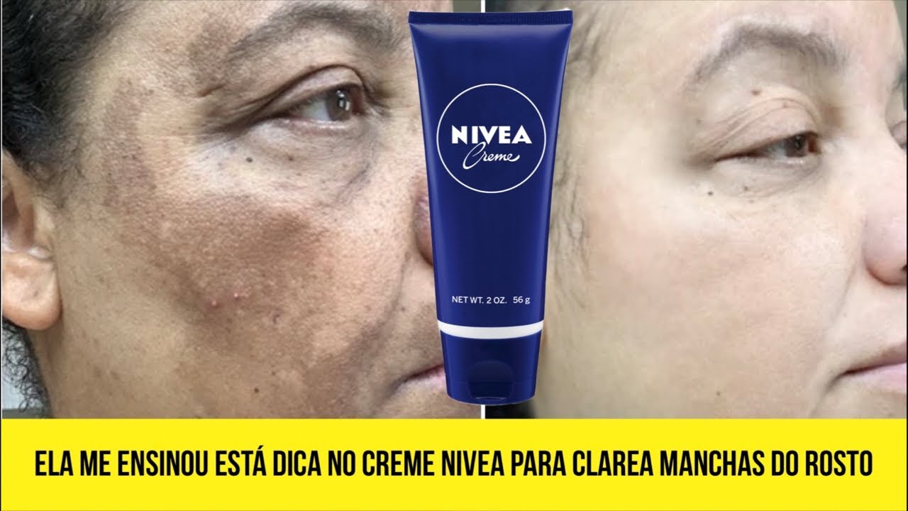 A 69-year-old woman shared her secret with me for lightening melasma ...
