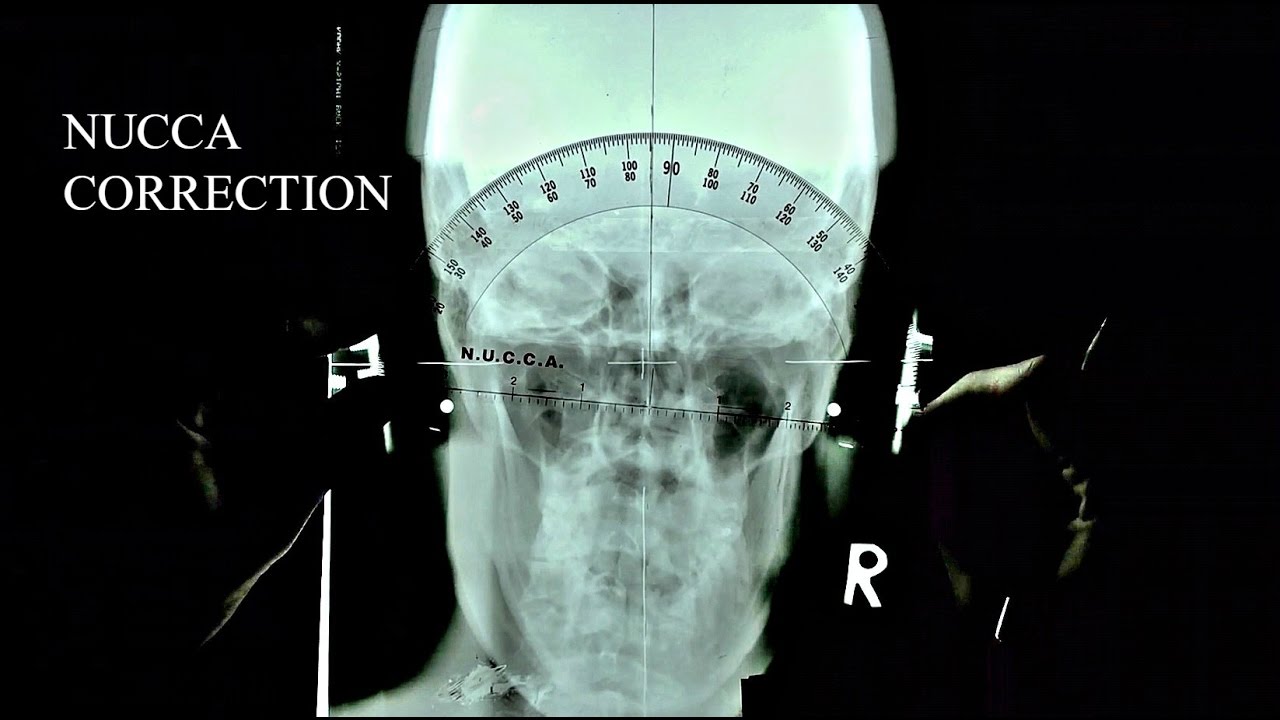 Upper Cervical Chiropractic - NUCCA - YouTube