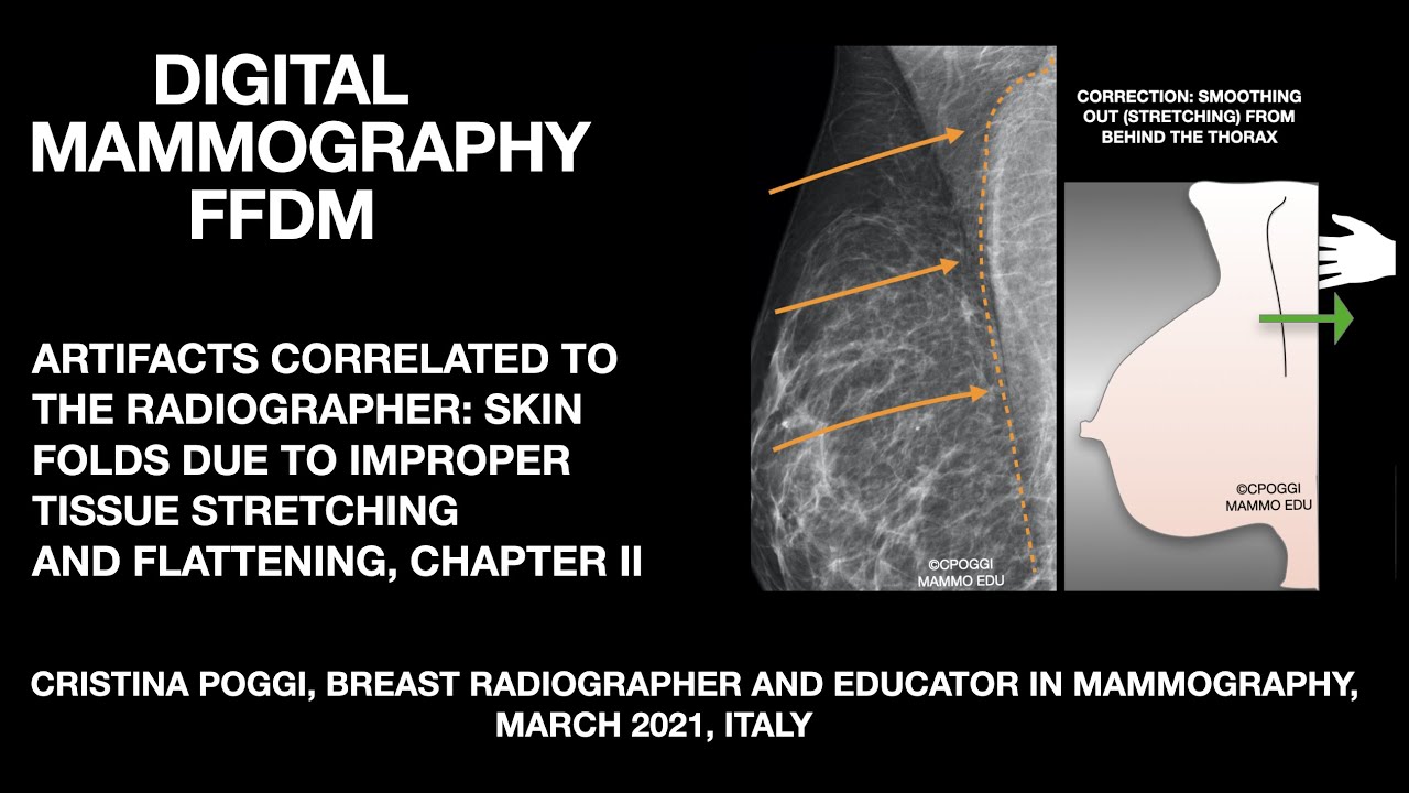 THE ARTIFACTS CORRELATED TO THE RADIOGRAPHER IN DIGITAL MAMMOGRAPHY ...