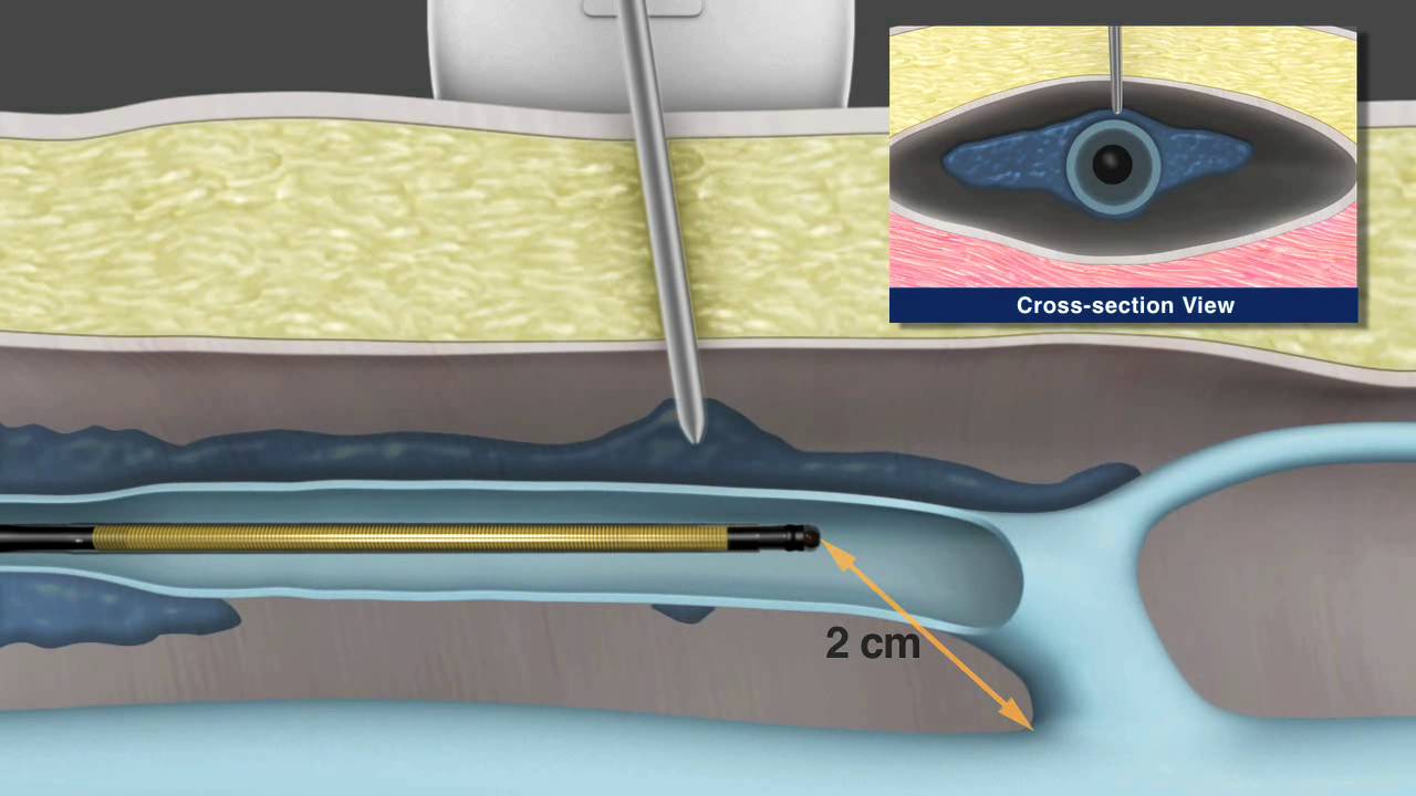 ClosureFast Procedure AnimationWMV file 2 - YouTube