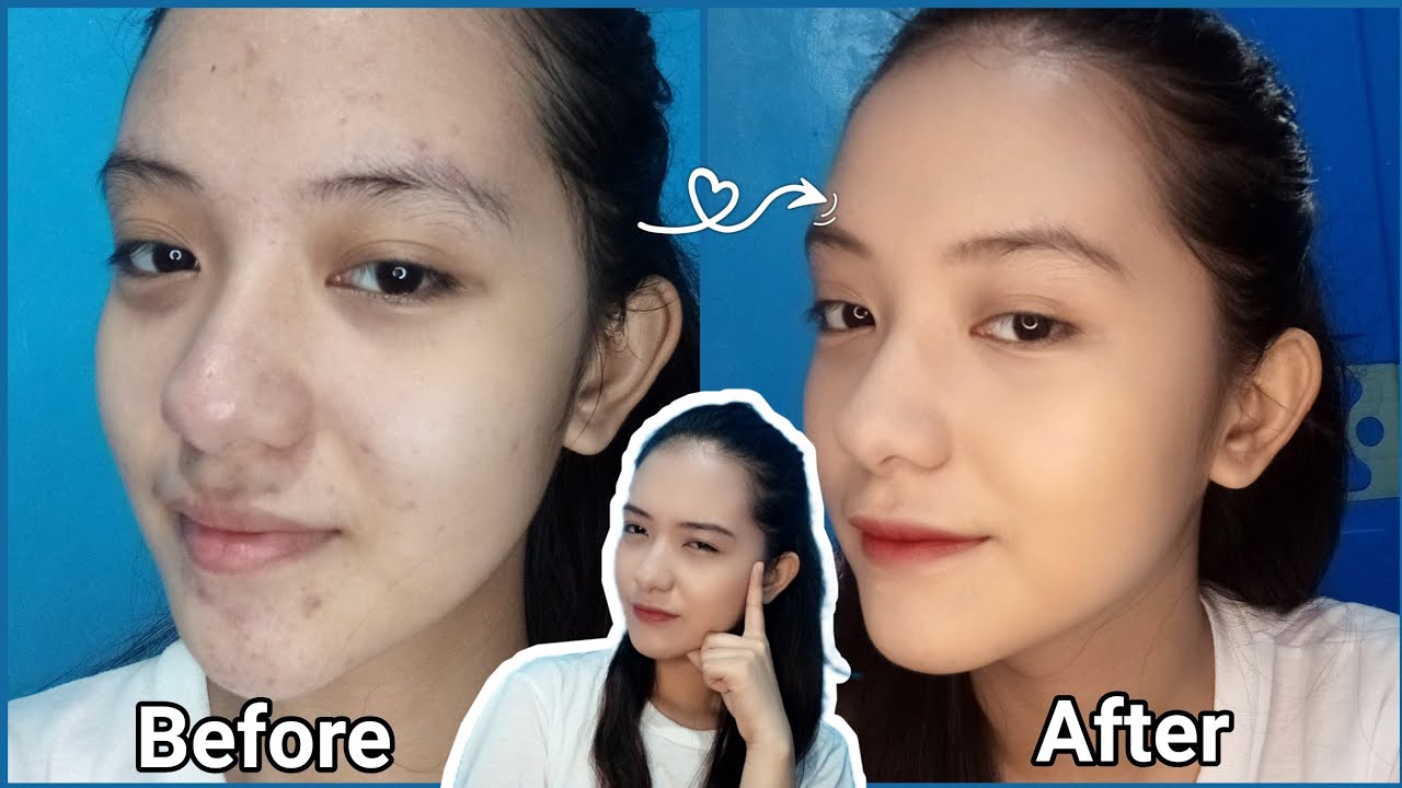 🌸How to cover pimples, acne and pimple marks using makeup? - YouTube