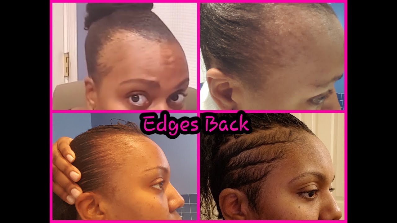 How I got my BALD EDGES BACK #BaldEdgeBeGone #HairLine - YouTube