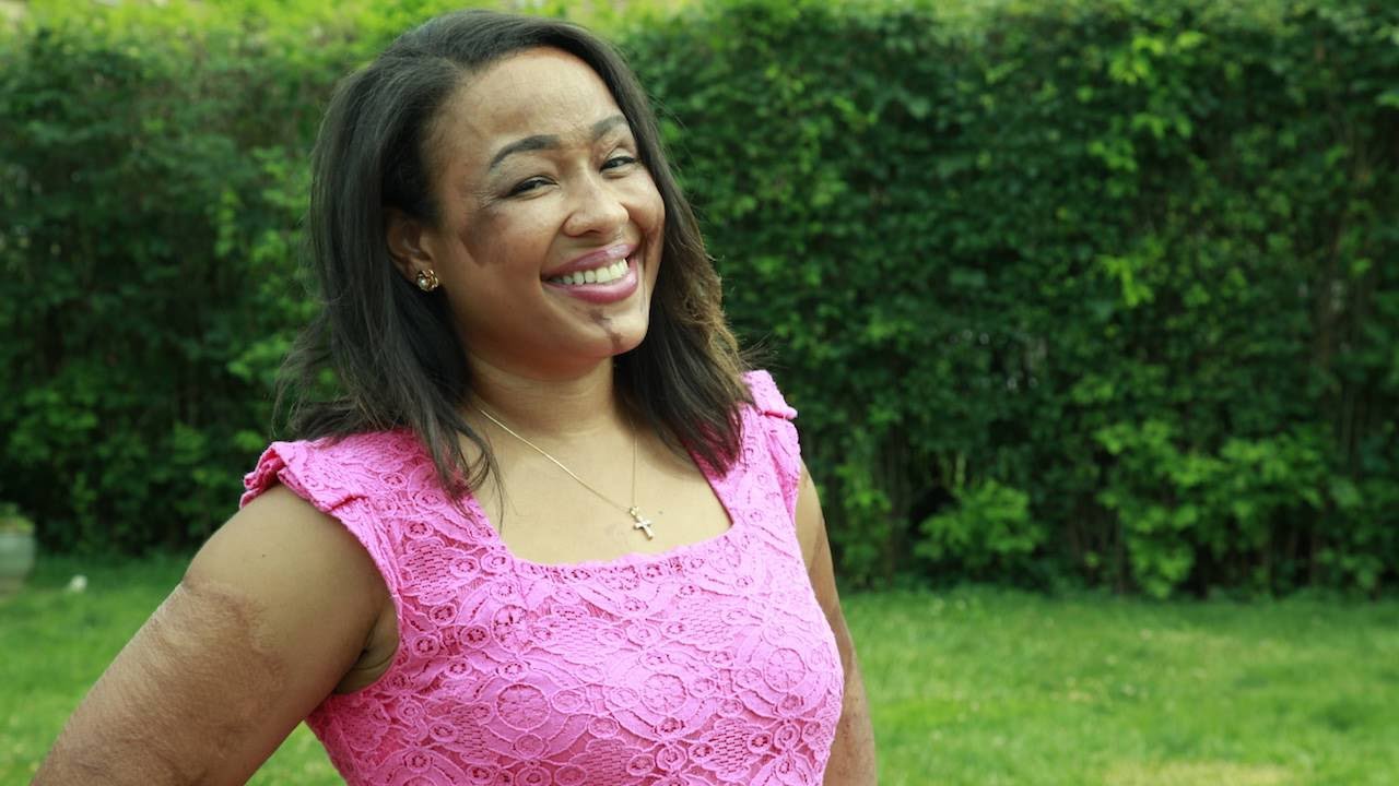 Acid Survivor: “I Love My Scars” - YouTube