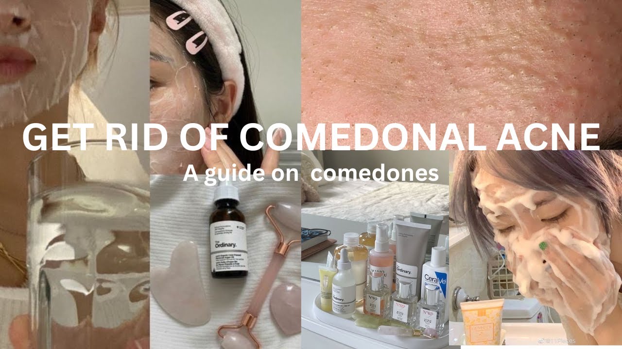 Comedonal acne causes & treatment || complete guide - YouTube