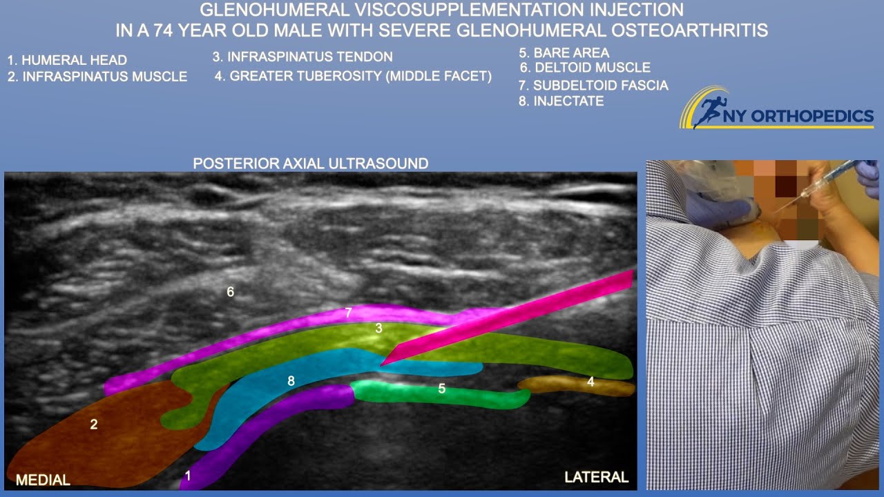 Ultrasound Guided Glenohumeral Shoulder Joint Injection in a 74 Year ...