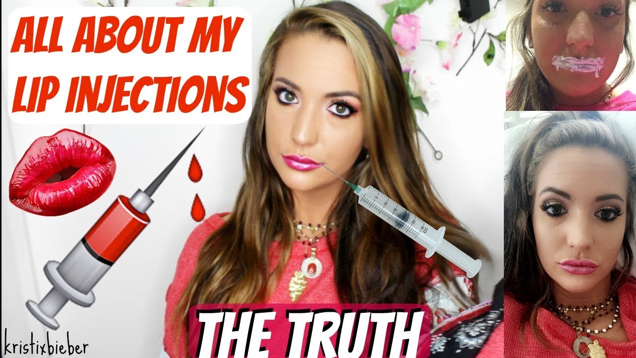 I GOT LIP INJECTIONS! - YouTube