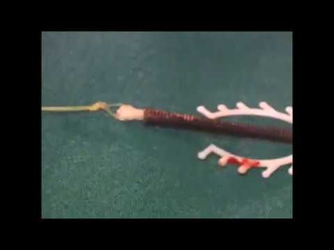 Missed IUCD ( Copper-T) removal by Hysteroscopy. - YouTube