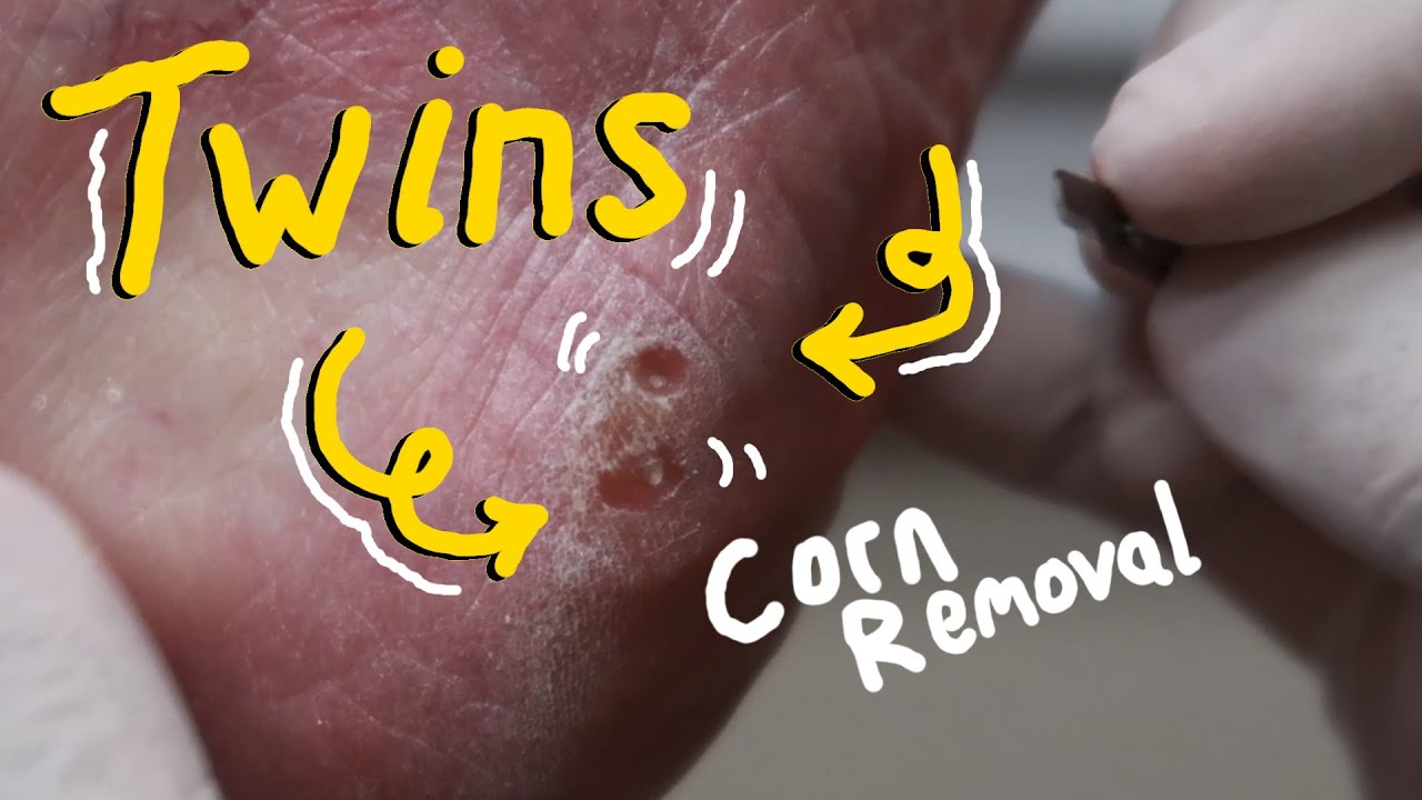Quick Satisfying Corn Removal! Twins in the heel!! - YouTube